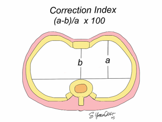 Pediatric Surgery Zone: The "correction index" as a measure of severity ...