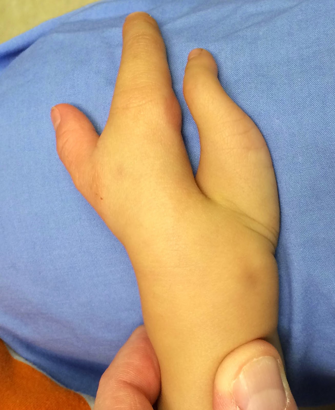 Ulnar Sided Cleft Hand | Congenital Hand and Arm Differences ...