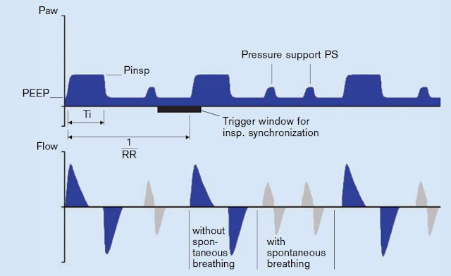 Class learning in Ventilator mode: 2017