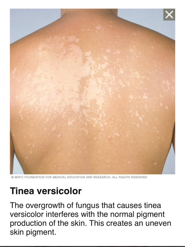 Merlins Micro World: Superficial mycoses- Tinea nigra, Piedra