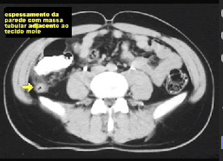 blog Rx,Tc e Rm....: APENDICITE AGUDA