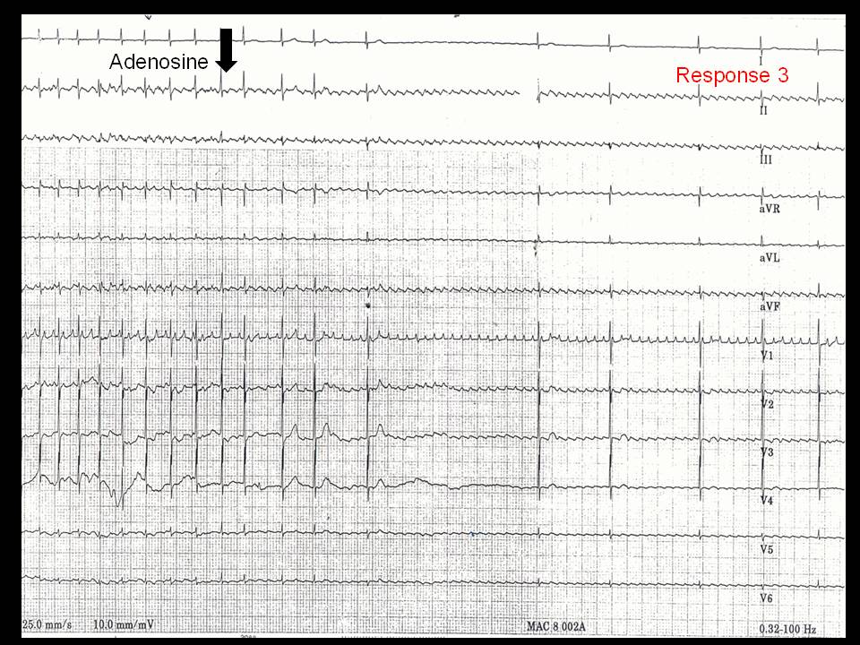 Pedi cardiology: Narrow Complex Tachycardia/SVT - 3 types of responses ...