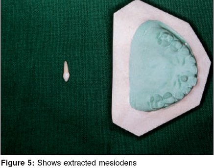 SUHASIS ONLINE: Erupted maxillary conical mesiodens in deciduous ...