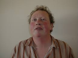 Semiología Quirúrgica Dra. Leroux R.: Facies