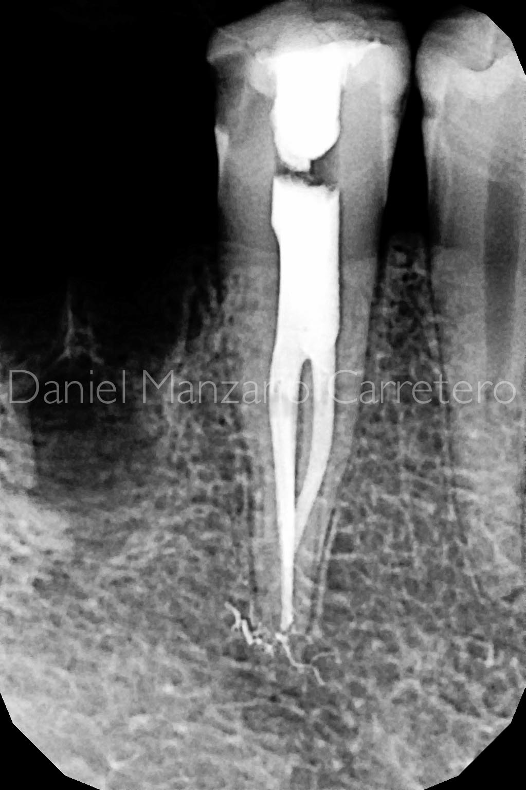 Master Endodoncia: CASO CLÍNICO: 45 Tipo III de Vertucci