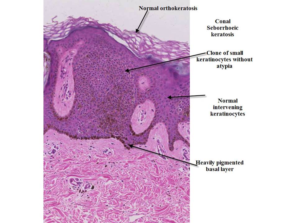 Dermpath Made Simple - Neoplastic: Seborrhoeic keratoses and Variants
