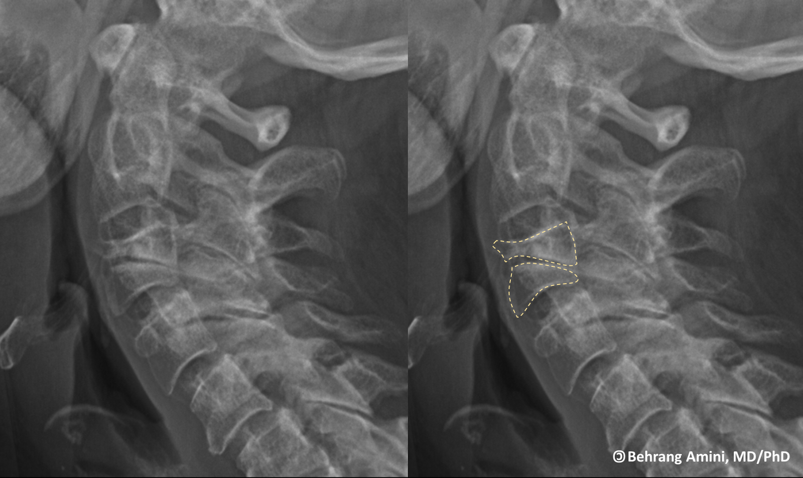 Roentgen Ray Reader: The Cervical Split: A Pseudofracture