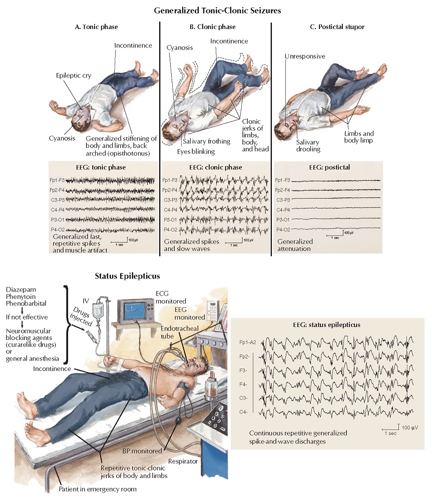 Epilepsy: Generalized Seizures and Status Epilepticus - pediagenosis