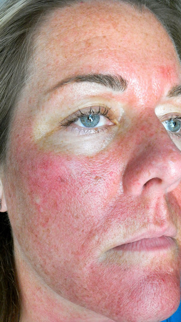 Efudex and Me 2013: Efudex Day Ten