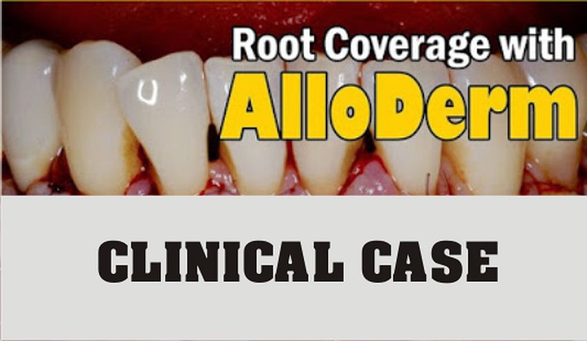 PERIODONTAL SURGERY: Root Coverage with AlloDerm