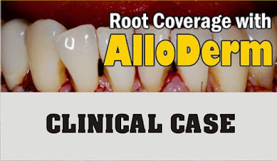 PERIODONTAL SURGERY: Root Coverage with AlloDerm