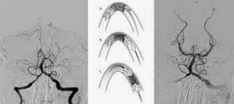 Medical Treatment Pictures-for Better Understanding: Thrombectomy ...
