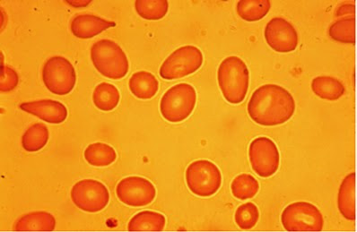 EL RINCÓN DE LA MEDICINA INTERNA: Mujer de 71 años con anemia perniciosa.