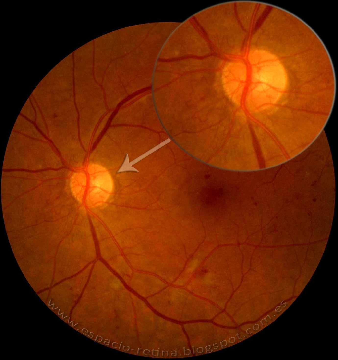 ESPACIO RETINA: Retinopatía diabética proliferativa.