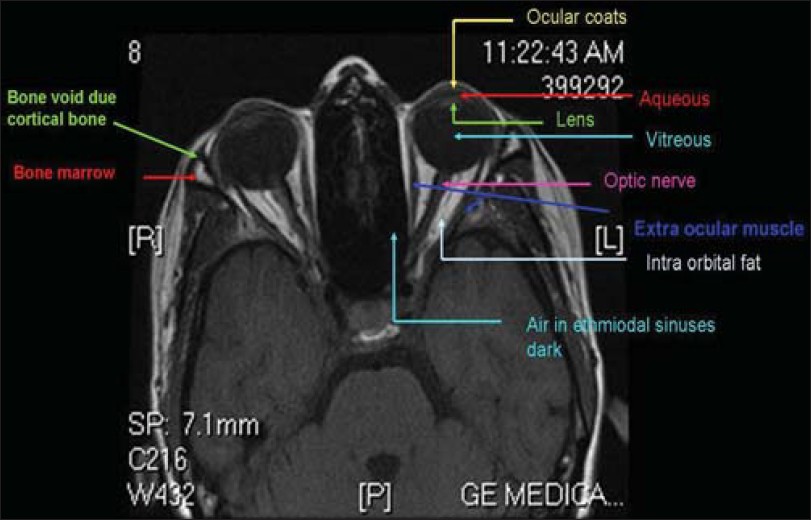 Orbit MRI Anatomy | Radiology Anatomy Images