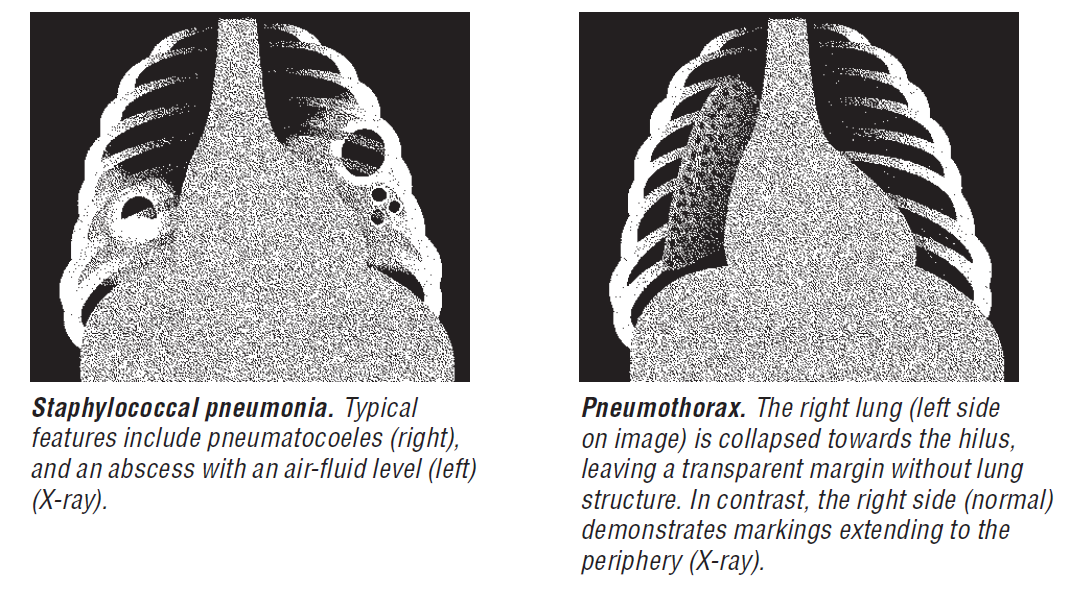 Pediatric Chest X-Ray Basic Interpretation Made Easy ~ NOCK CONSULTATION