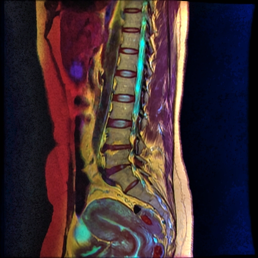 Nevit's blog: Color MRI of the Lumbar spine with extruded disc