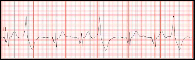 Practice EKG Strips