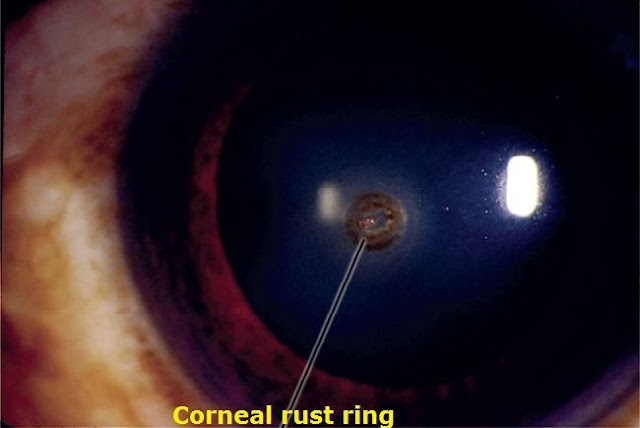 Ophthalmology Notes: Rings in ophthalmology