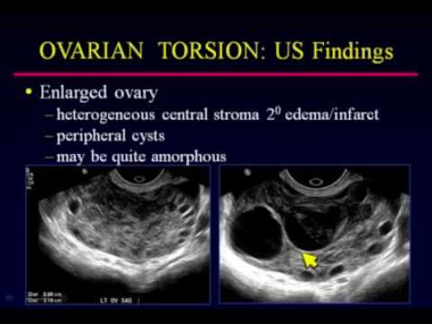 MEDICAL ULTRASOUND/TORSION OF OVARY