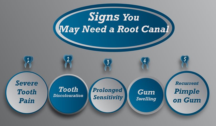 Signs That You Need a Root Canal