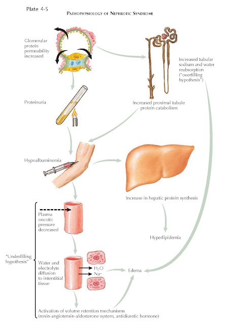 Overview Of Nephrotic Syndrome - pediagenosis