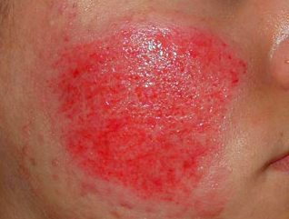 BeautyTips&Tricks: Side Effects of Derma Roller Treatments