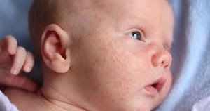 Drool Rash Treatment & Home Remedies