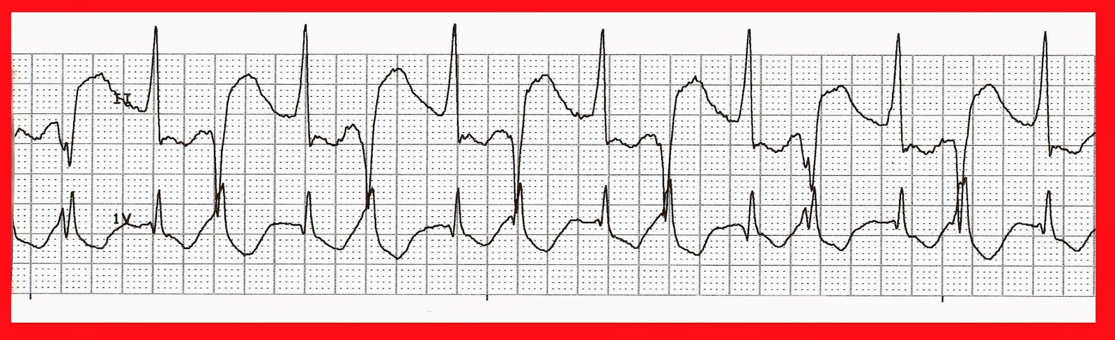 Float Nurse: Practice Rhythm Strips 288