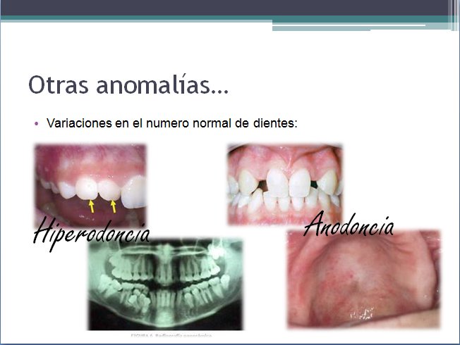 DENTAL 1001 UNAM: Macro y Microdoncia, y otras Anomalías Dentales ...