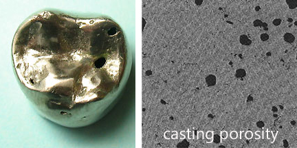 Regular PFM (Porcelain Fused To Metal) Crown And Bridge ~ Dr. Bharat Katarmal Dental & Implant ...