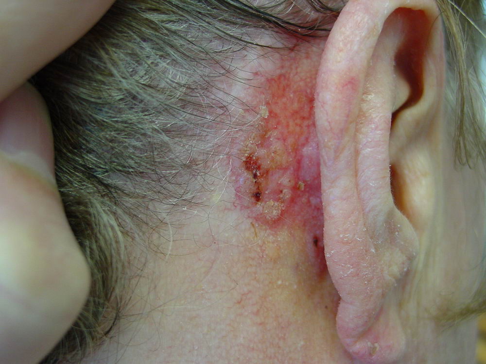 Dermatology For Dentists and Dental Students: Ears