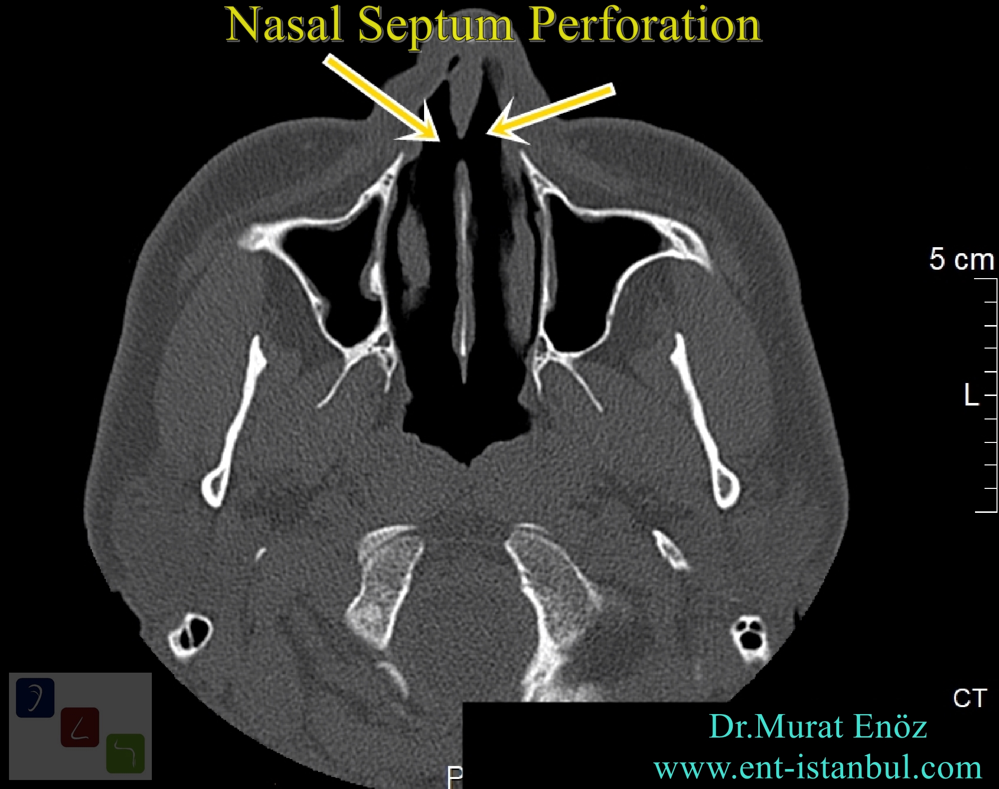 We Performed Again Revision Rhinoplasty Operation + Septum Perforation ...