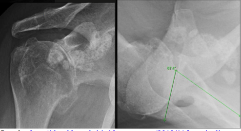 UW Shoulder and Elbow Academy: Shoulder Arthritis: The Cliff Notes for ...