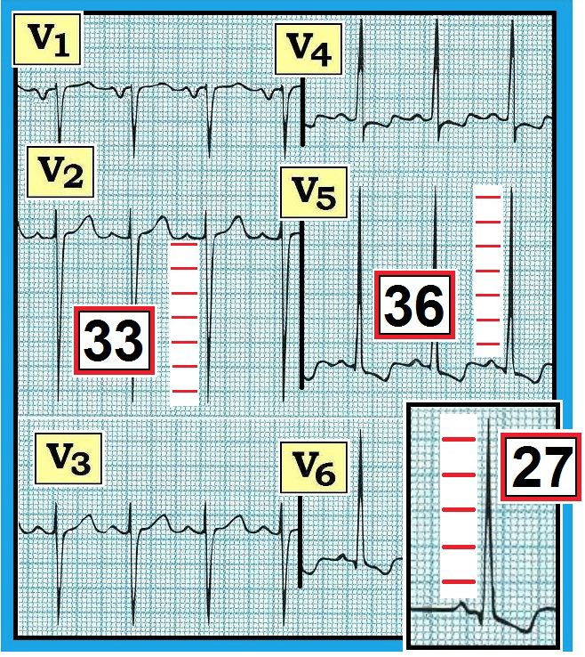 ECG Interpretation: ECG Blog #154 (STEMI - Inferior - Posterior - LVH ...