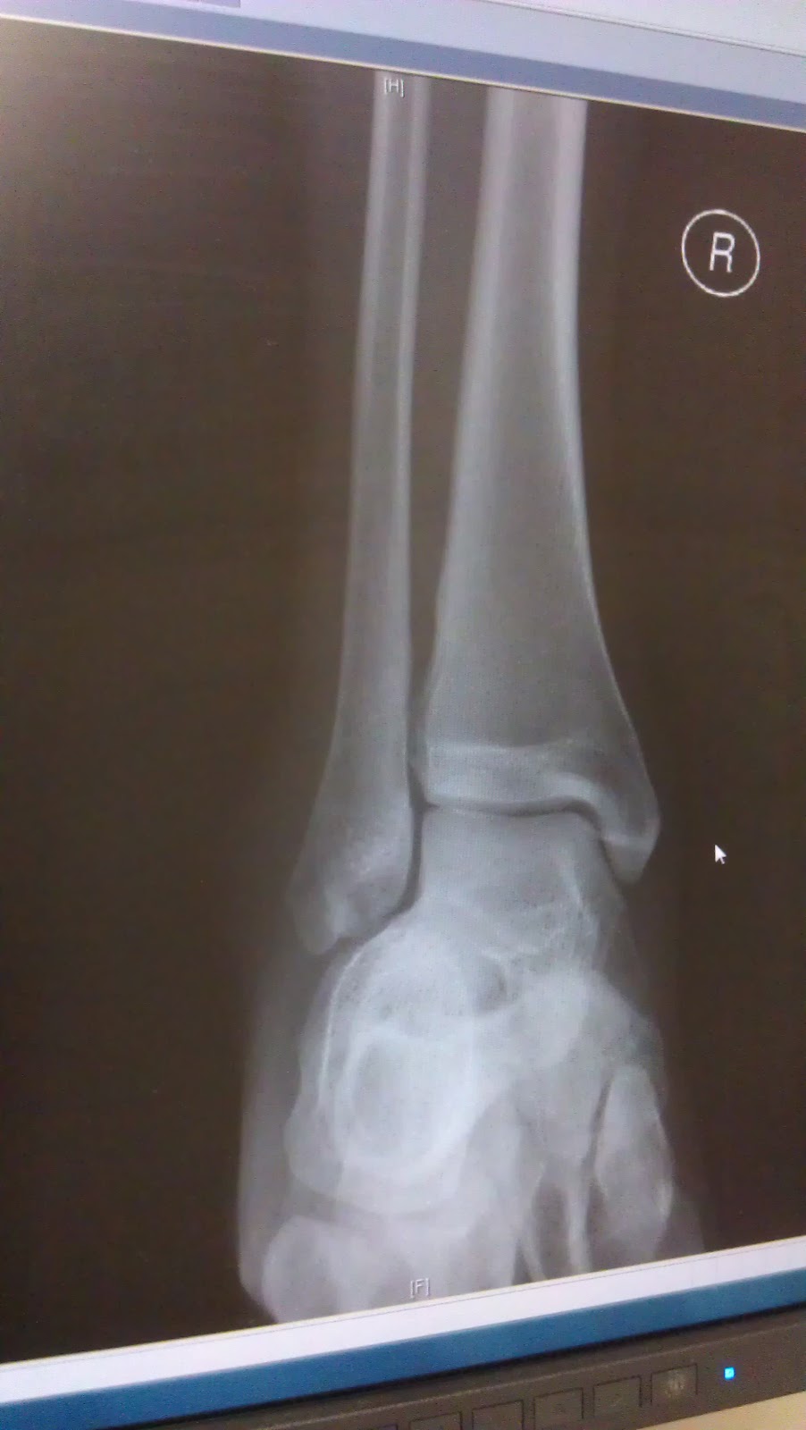 the optimistic runner: Weber A fracture - ankle