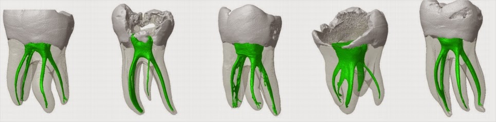 The Root Canal Anatomy Project: JOE Publication: Radix