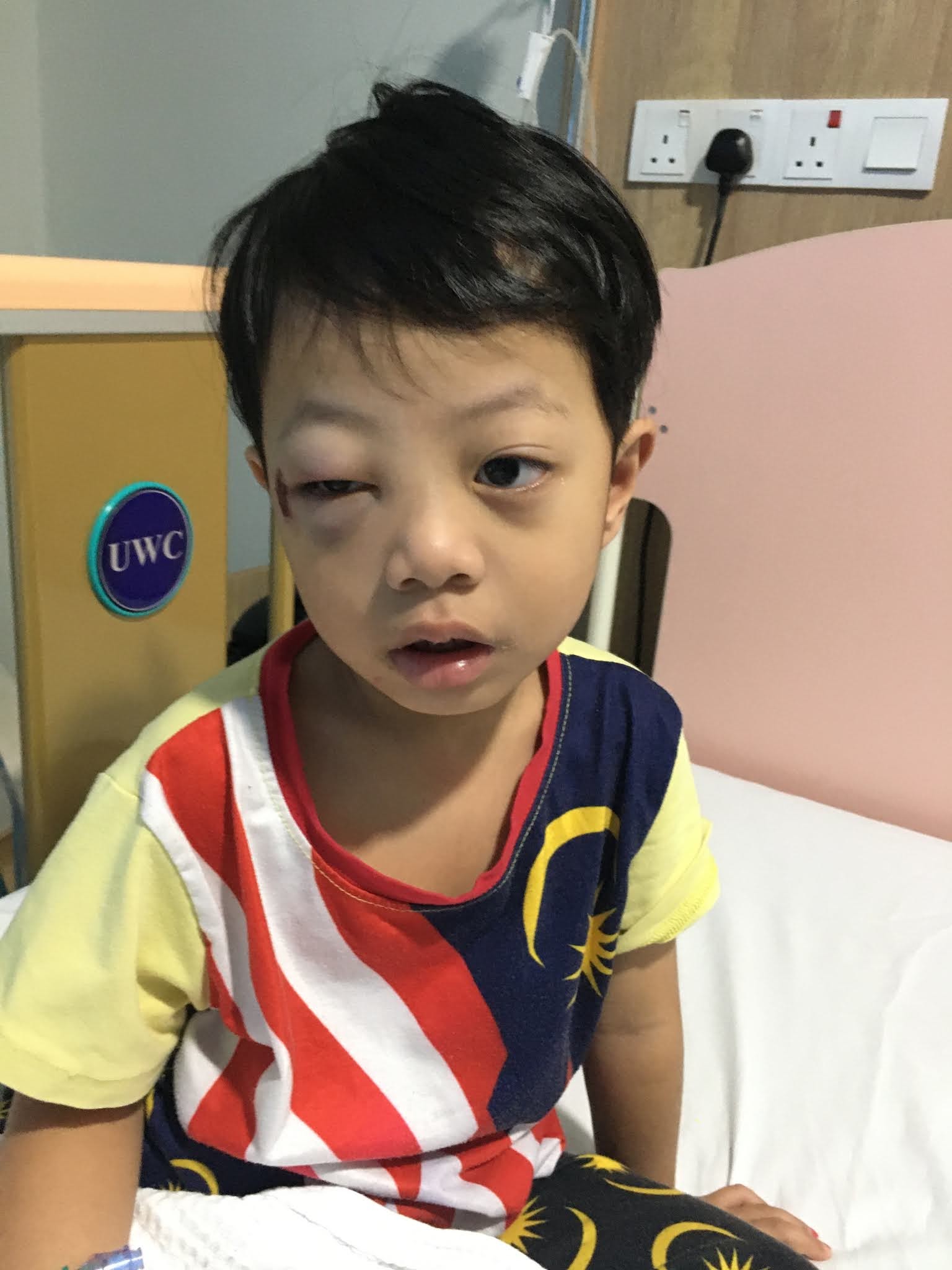 RACOON EYES AFTER A TRAUMATIC HEAD INJURY