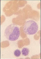 HEMATOLOGIA: METAMIELOCITO