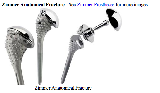 Shoulder and Elbow Surgery: Identifying the implanted shoulder ...