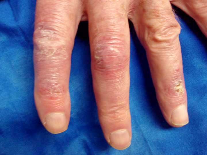 VIRTUAL GRAND ROUNDS IN DERMATOLOGY 2.0: Dermatomyositis?