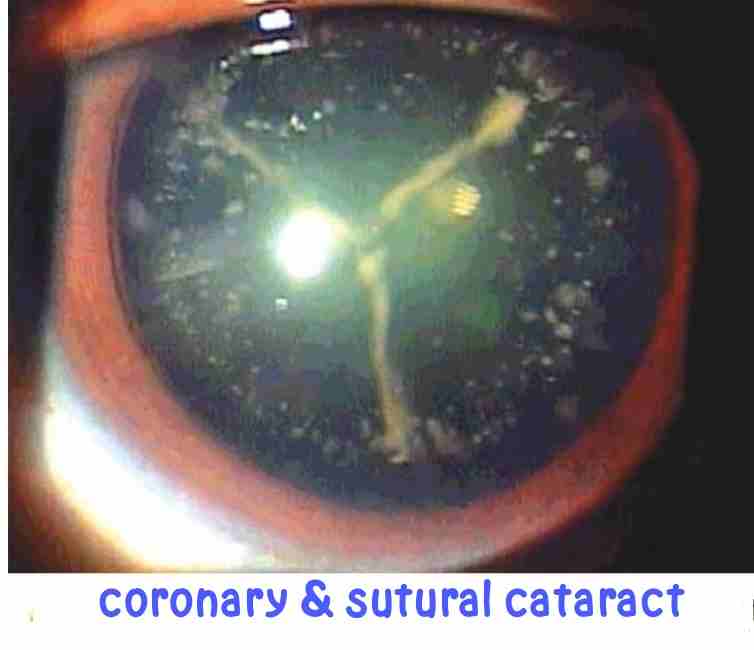 What is Cataract? causes, etiology pathophysiology