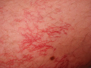 VIRTUAL GRAND ROUNDS IN DERMATOLOGY 2.0: Unusual Vascular Pattern