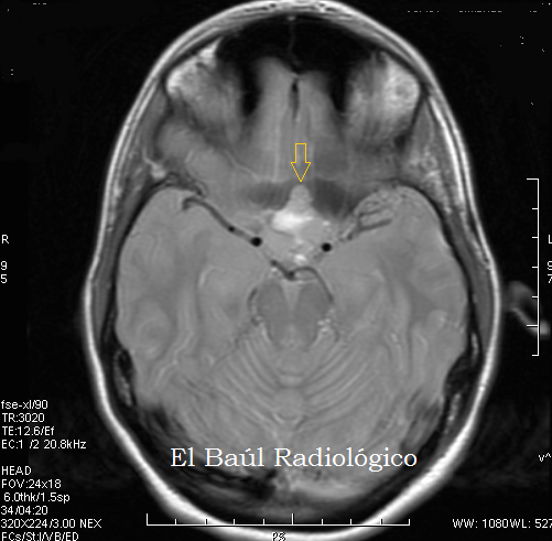 El Baúl Radiológico: 2) QUISTE DERMOIDE INTRACRANEAL (Intracranial ...