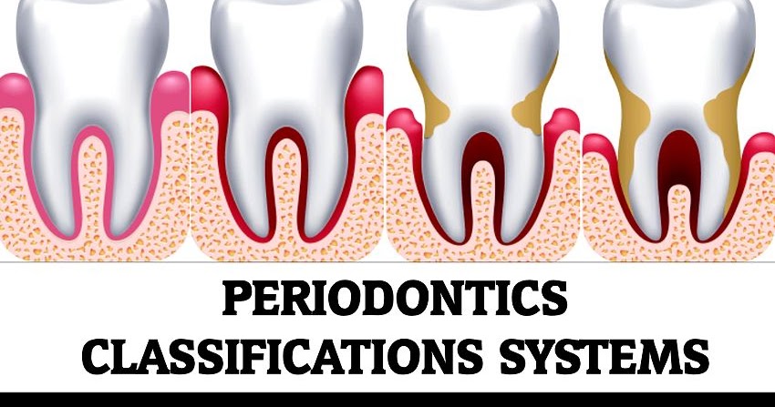 PERIODONTICS: Classifications systems - Odonto-Tv