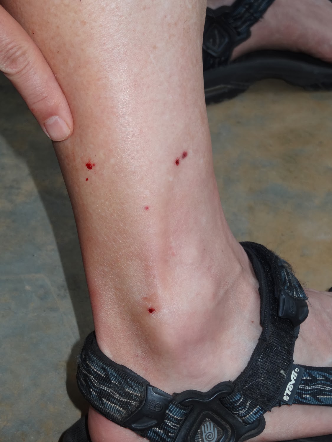 Leech Bite Infection