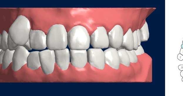 Petting Life: Half Way Through My Smile Direct Club Treatment Now!