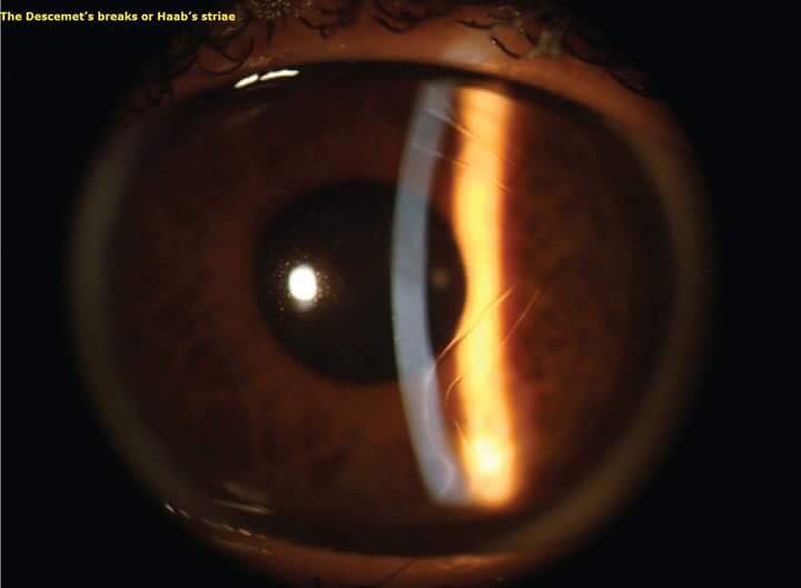 Ophthalmology Notes: Lines in Ophthalmology