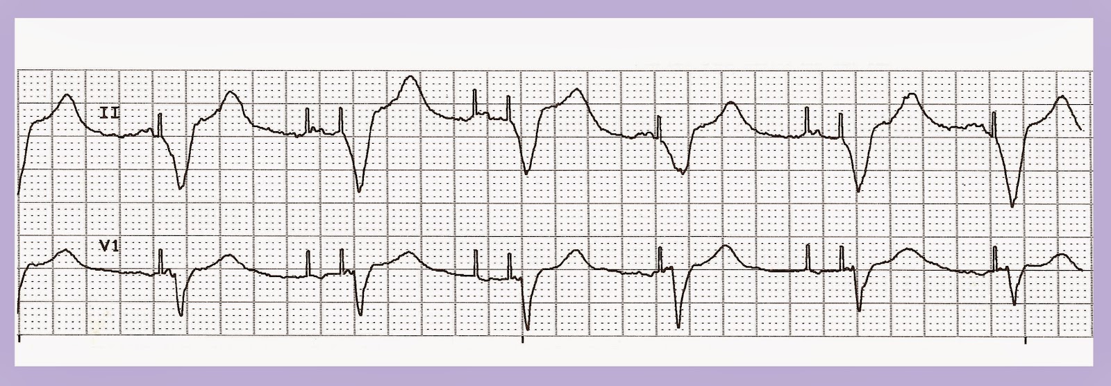 Float Nurse: Practice EKG Strips 391