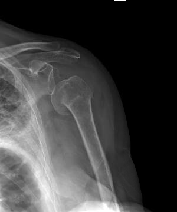 Shoulder and Elbow Surgery: Shoulder subluxation after proximal humerus ...